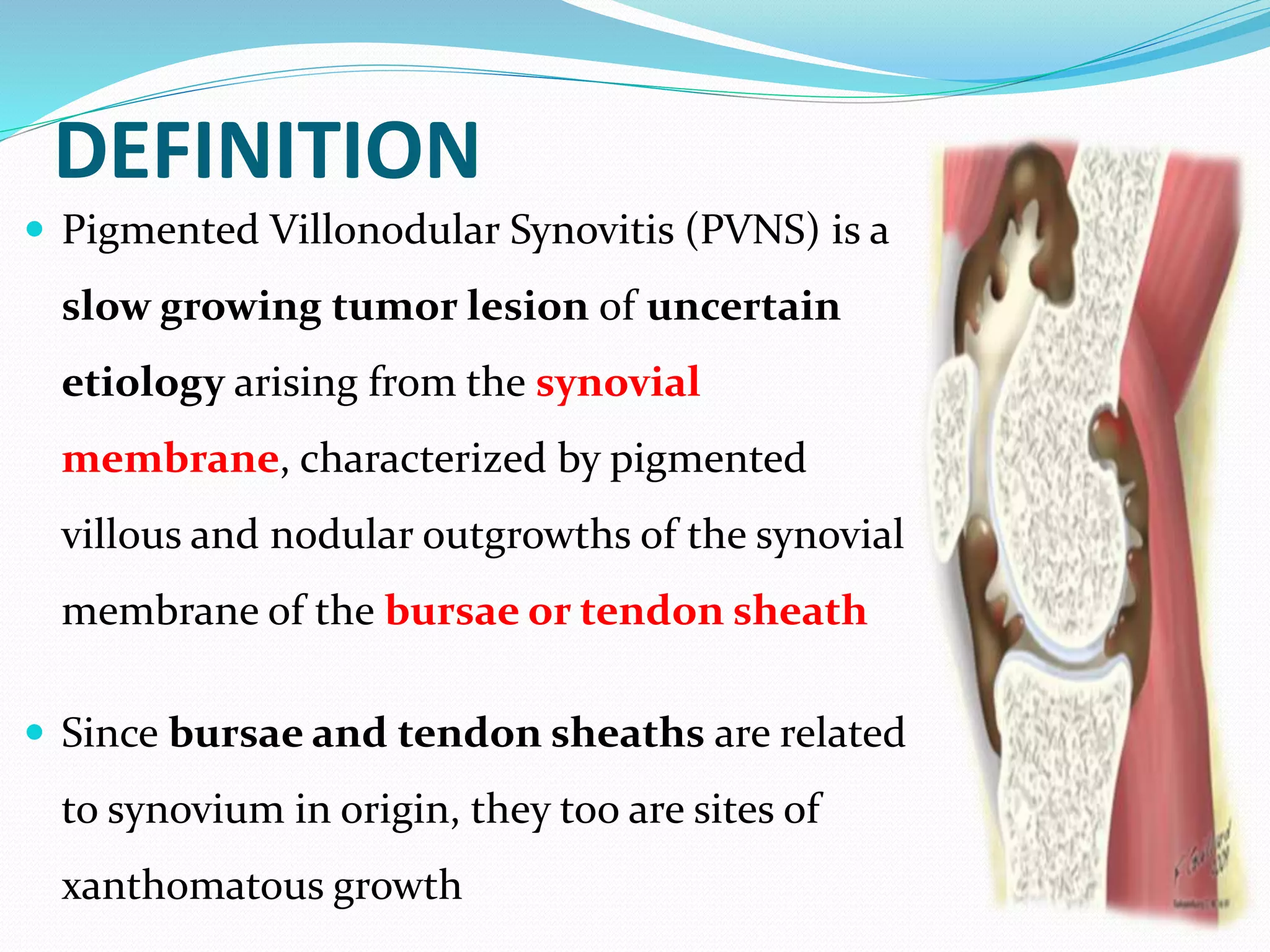 Pigmented villonodular synovitis | PPTX
