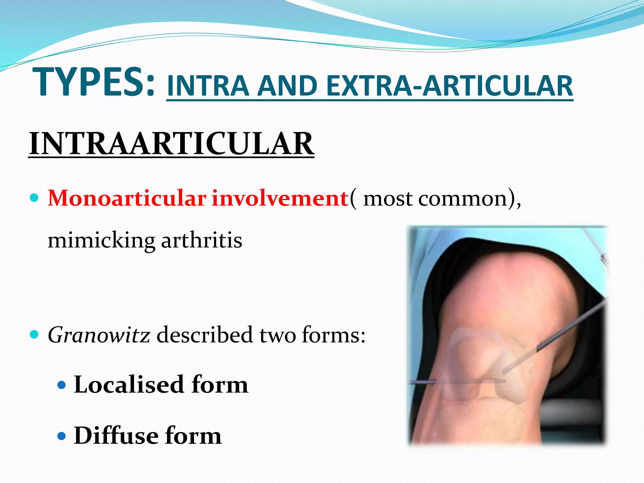 Pigmented villonodular synovitis | PPTX