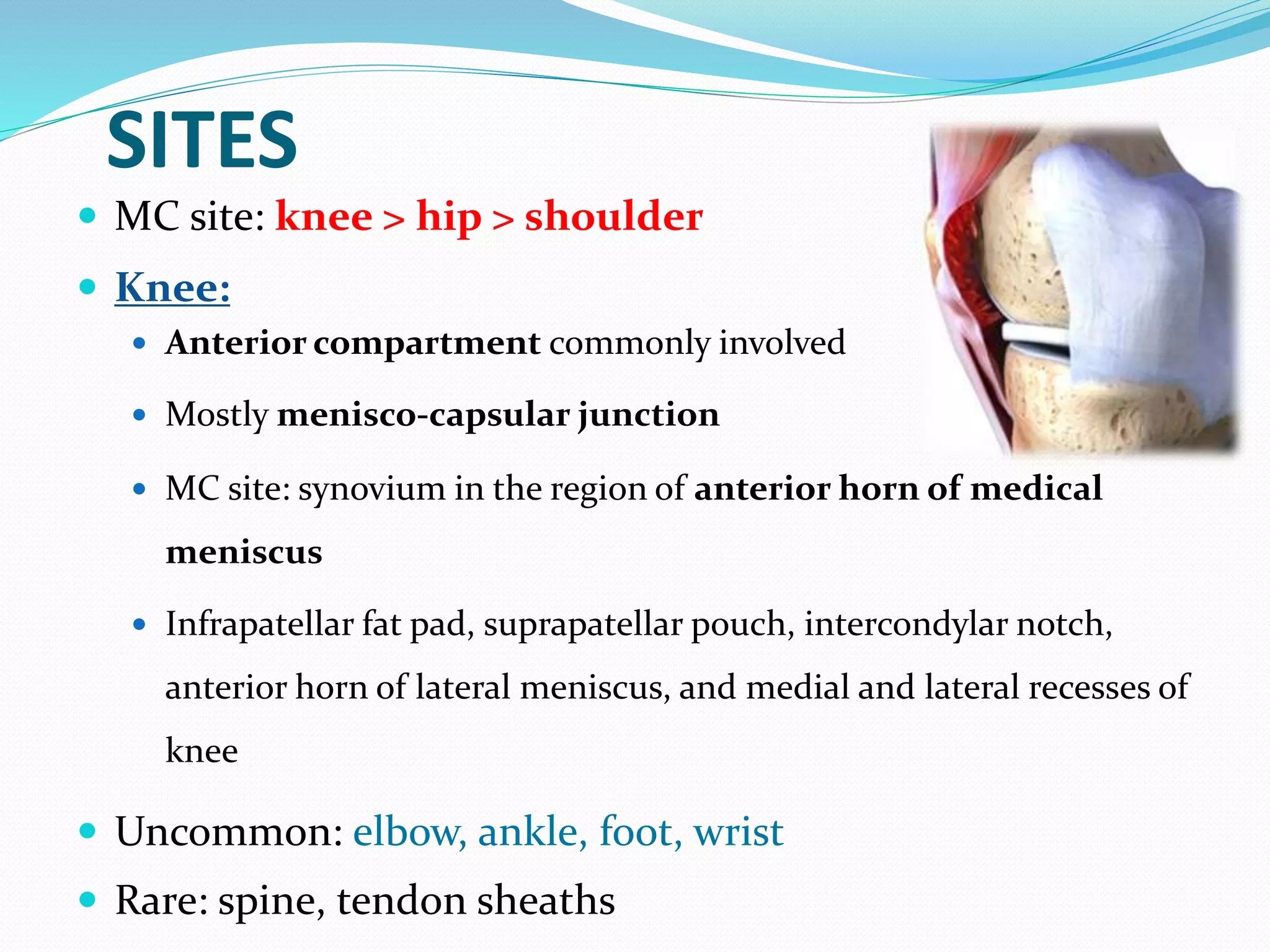 Pigmented villonodular synovitis | PPTX