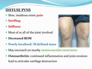 Pigmented villonodular synovitis | PPTX