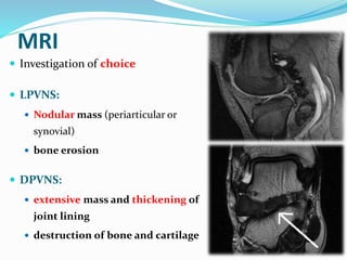 Pigmented villonodular synovitis | PPTX