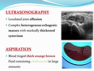 Pigmented villonodular synovitis | PPTX