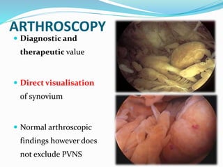 Pigmented villonodular synovitis | PPTX