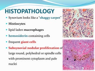 Pigmented villonodular synovitis | PPTX