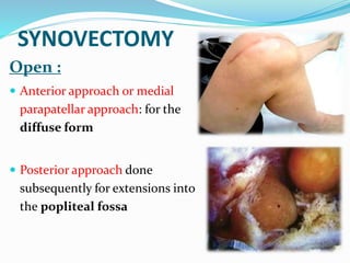 Pigmented villonodular synovitis | PPTX