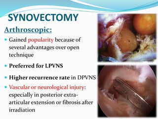 Pigmented villonodular synovitis | PPTX