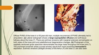 PVNS,SYNOVIAL CHONDROMATOSIS & LOOSE BODIES | PPTX