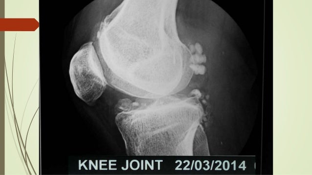 PVNS,SYNOVIAL CHONDROMATOSIS & LOOSE BODIES