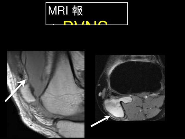 Pigment villos nodular Synovitis PVNS