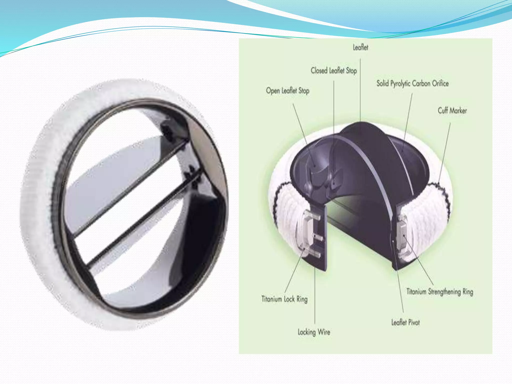 PROSTHETIC VALVES | PPTX