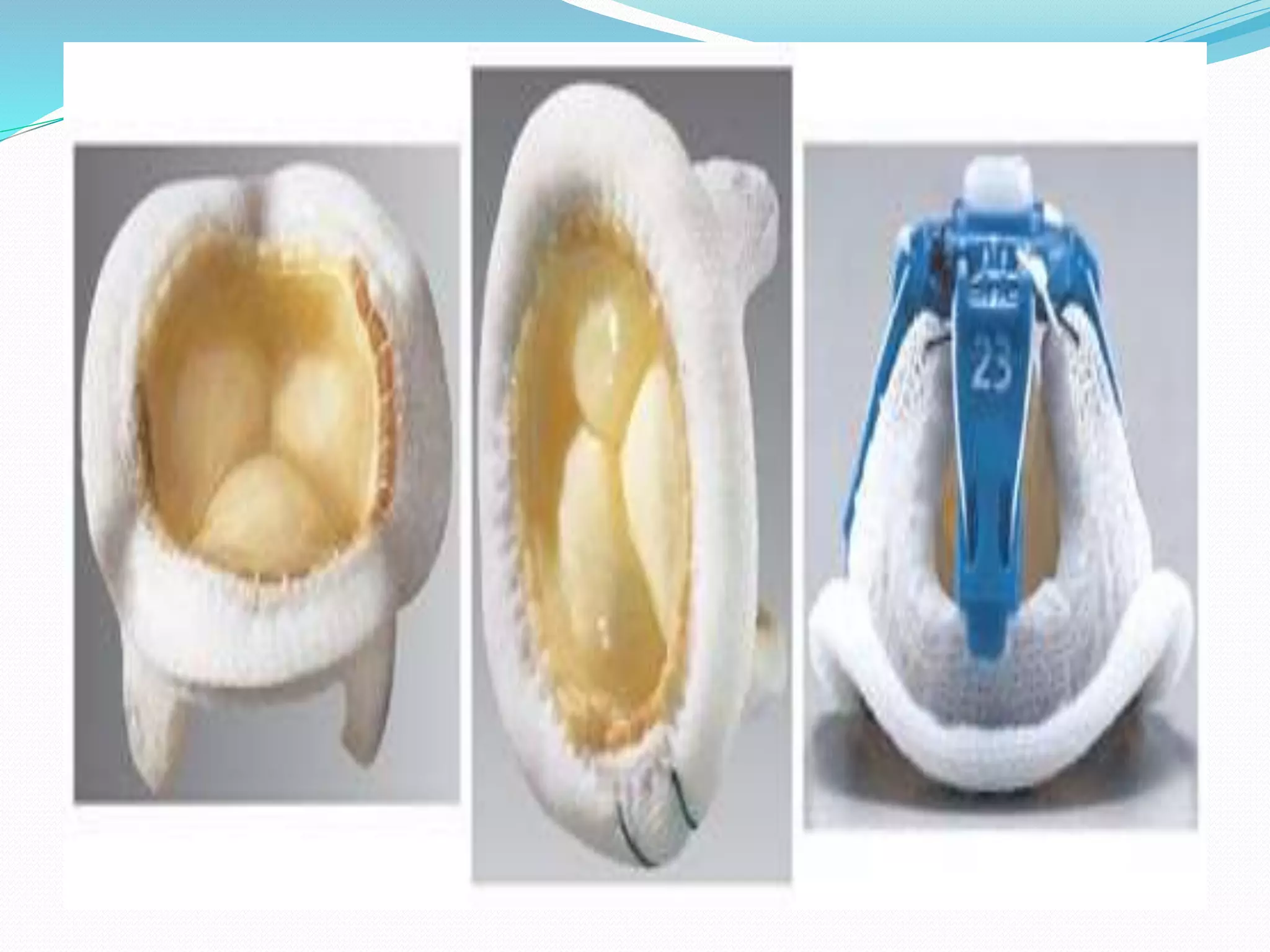 PROSTHETIC VALVES | PPTX