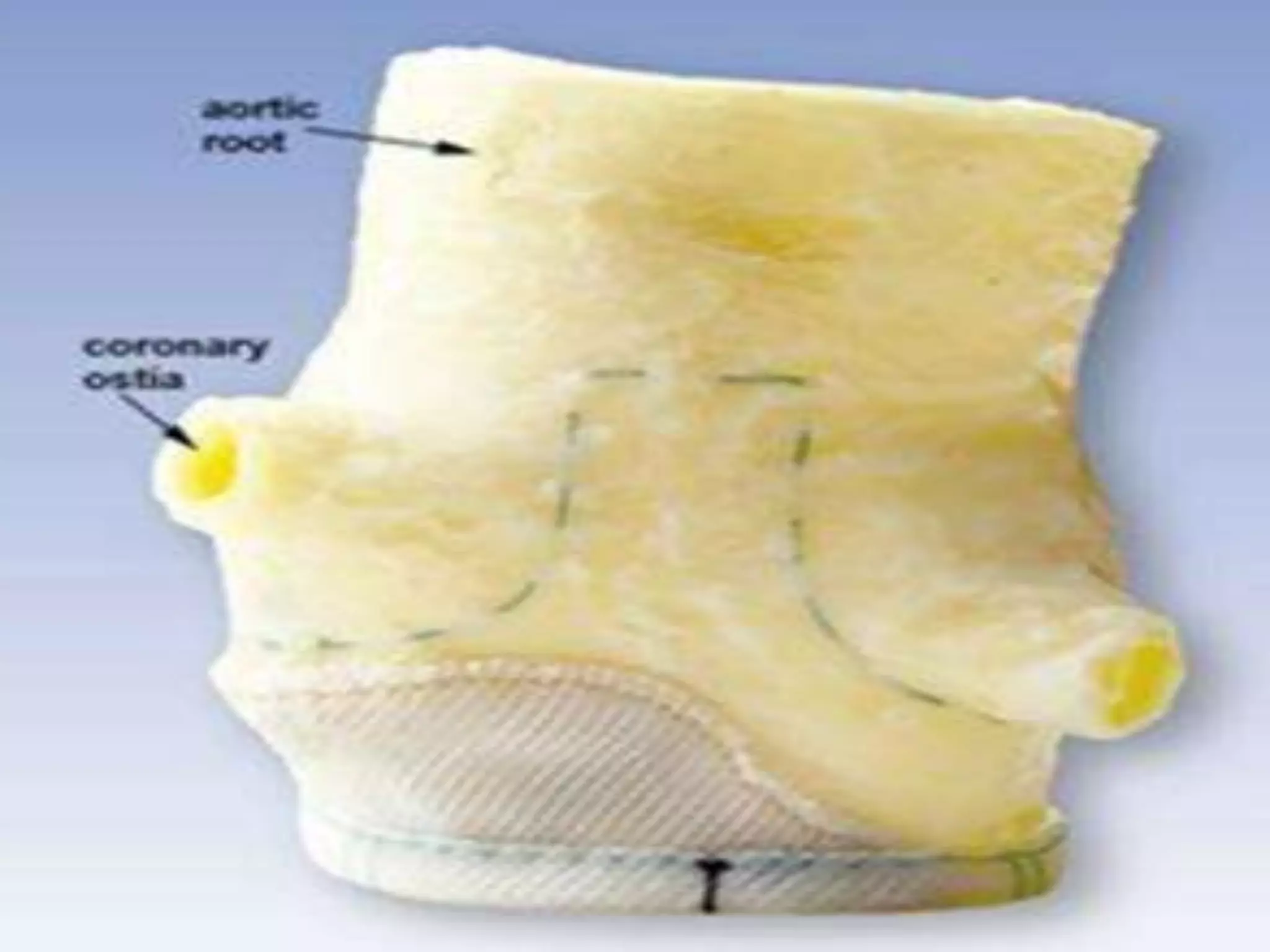 PROSTHETIC VALVES | PPTX