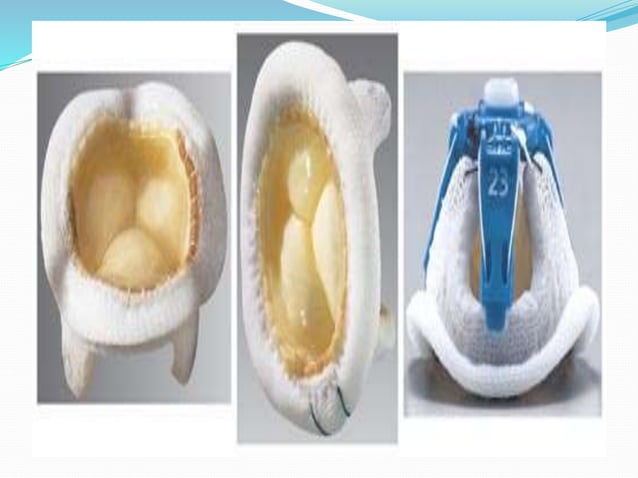 PROSTHETIC VALVES | PPTX