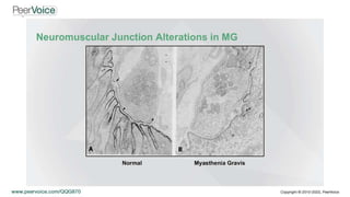 Complement-Mediated Attack of the Neuromuscular Junction in gMG: The C5 Inhibitors | PPT