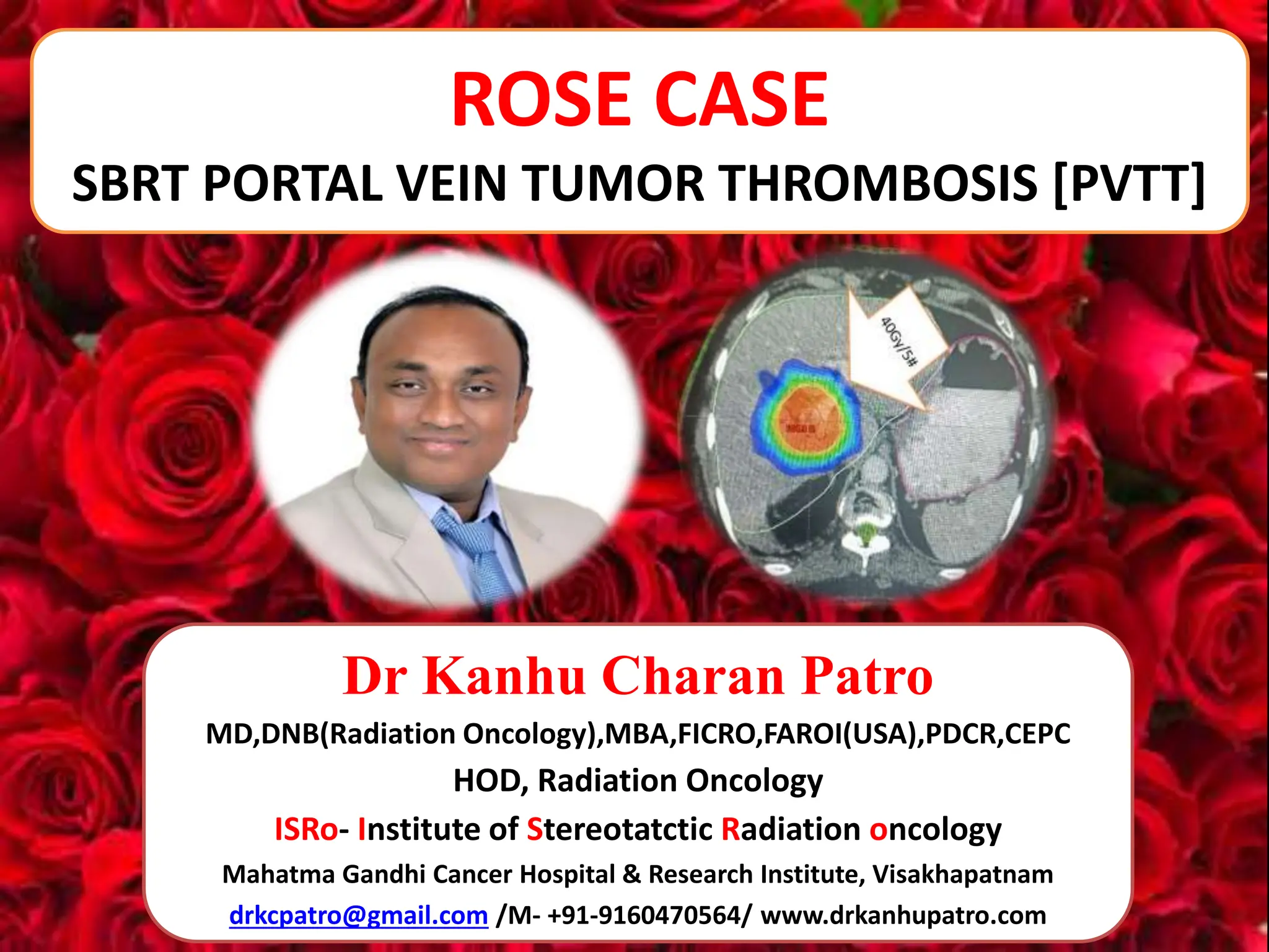 PORTAL VEIN TUMOR THROMBOSIS SBRT/DR KANHU CHRAN PATRO | PPTX