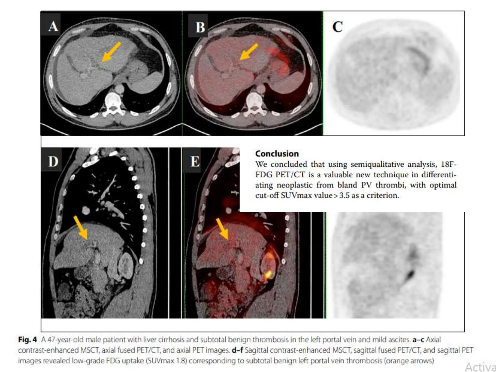 PORTAL VEIN TUMOR THROMBOSIS SBRT/DR KANHU CHRAN PATRO | PPTX