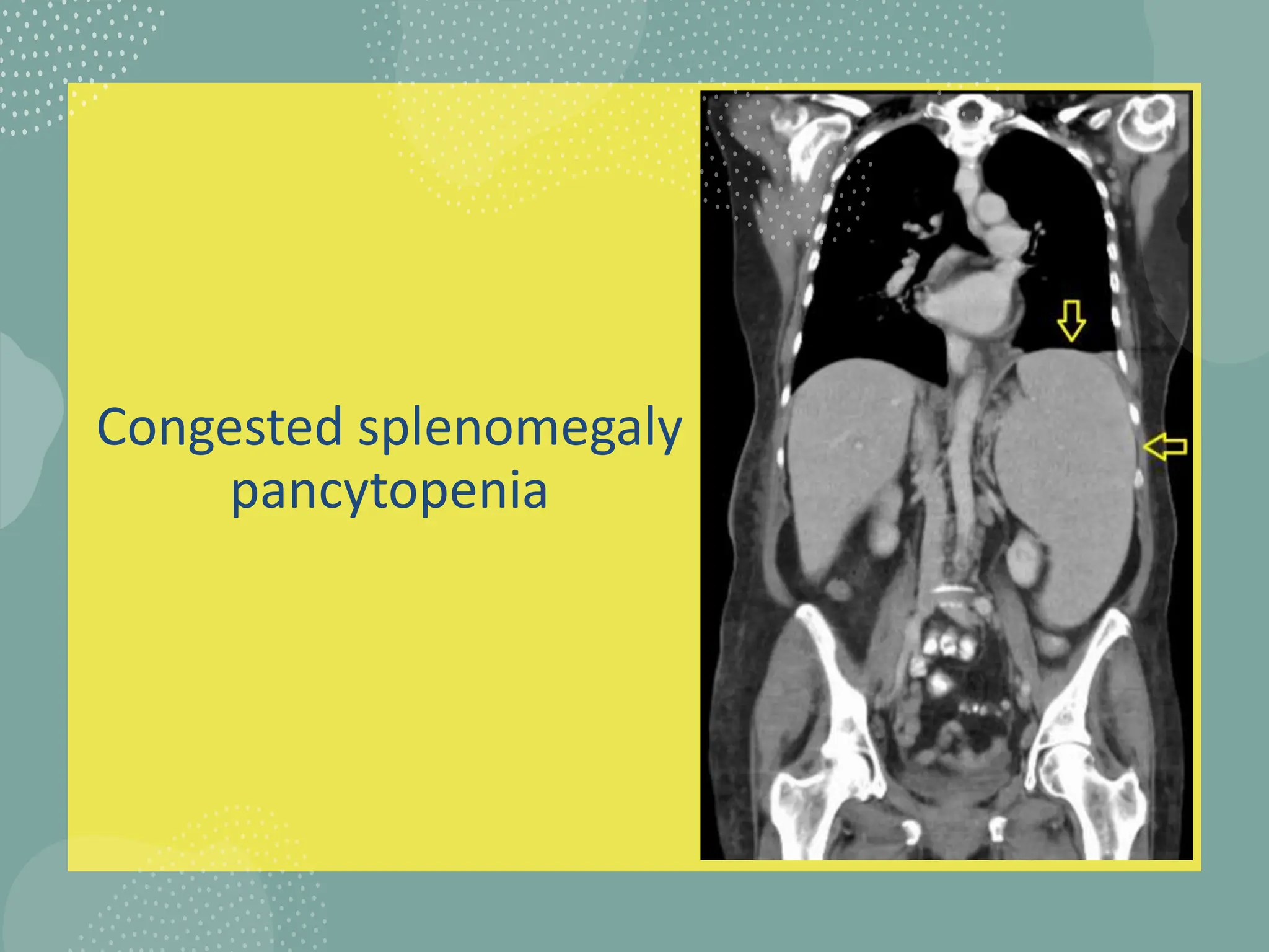 PORTAL VEIN TUMOR THROMBOSIS SBRT/DR KANHU CHRAN PATRO | PPTX