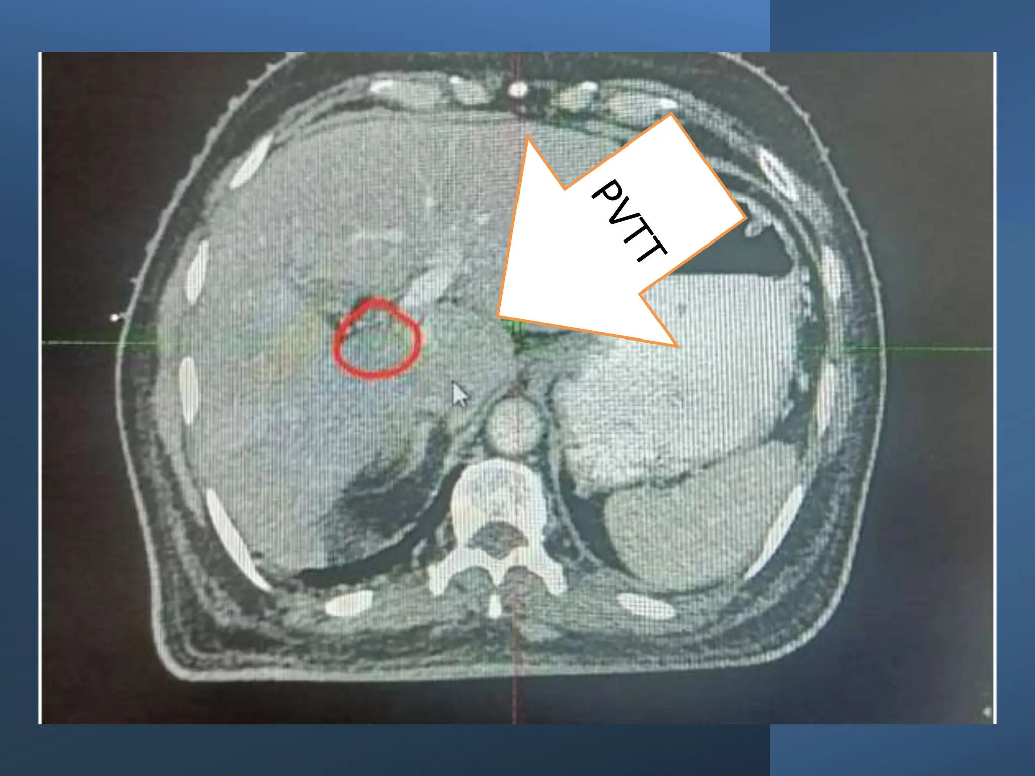 PORTAL VEIN TUMOR THROMBOSIS SBRT/DR KANHU CHRAN PATRO | PPTX