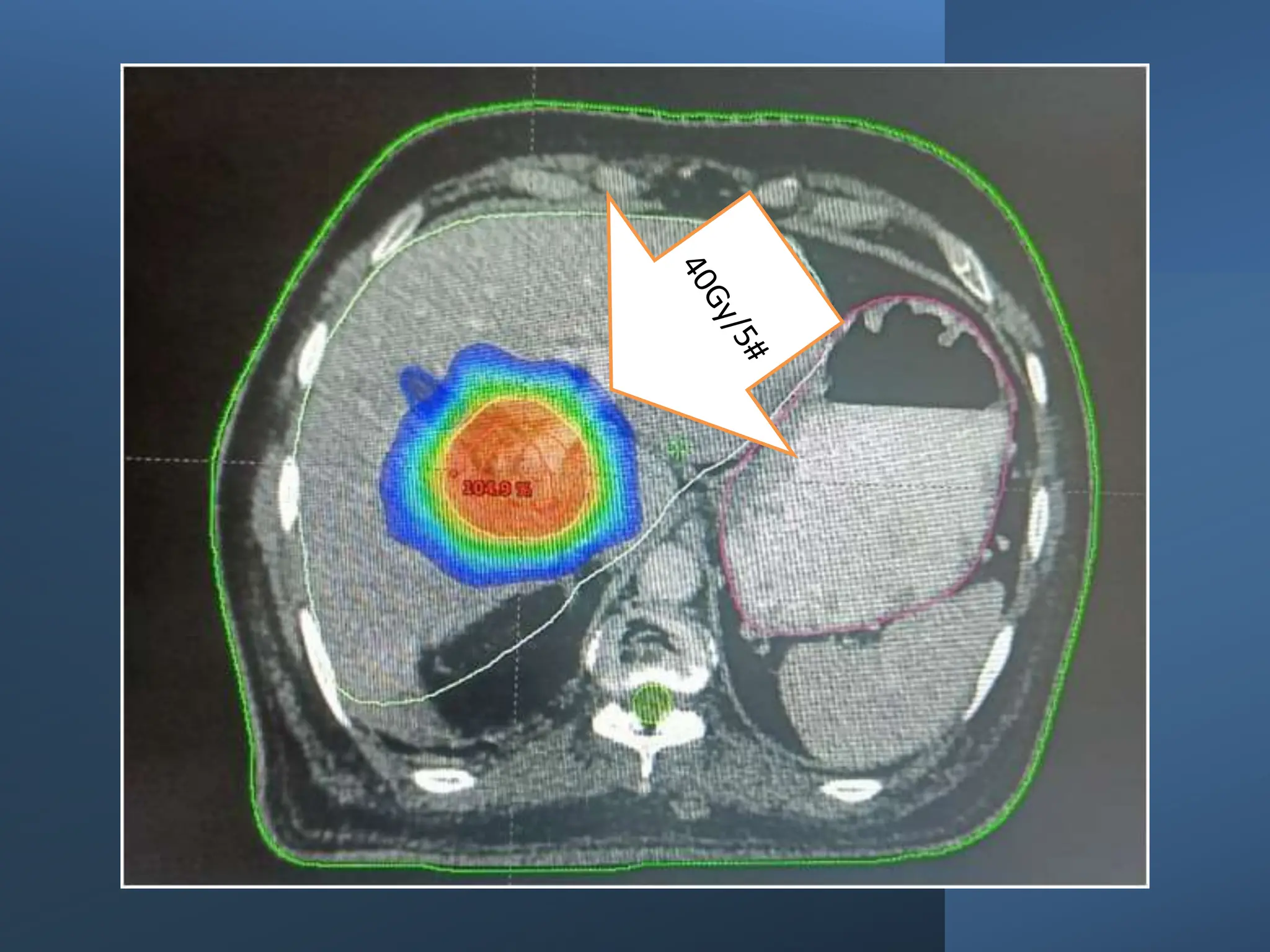 PORTAL VEIN TUMOR THROMBOSIS SBRT/DR KANHU CHRAN PATRO | PPTX