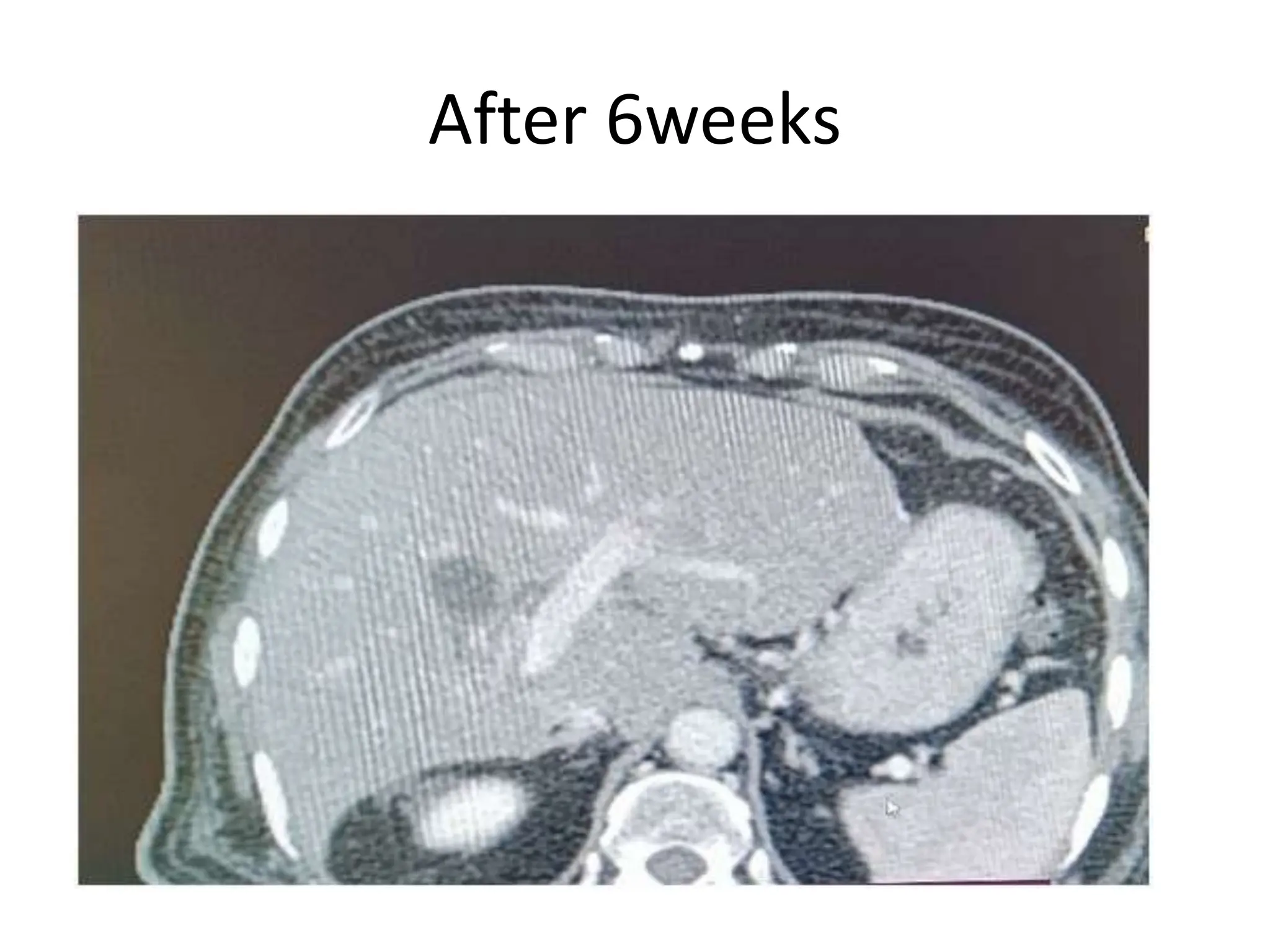 PORTAL VEIN TUMOR THROMBOSIS SBRT/DR KANHU CHRAN PATRO | PPTX