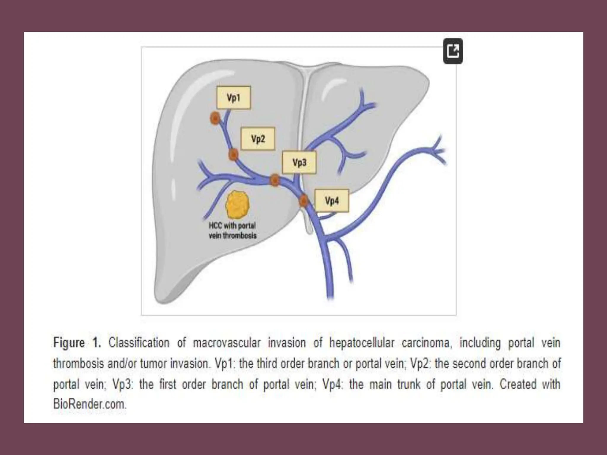 PORTAL VEIN TUMOR THROMBOSIS SBRT/DR KANHU CHRAN PATRO | PPTX
