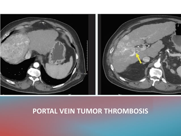 PORTAL VEIN TUMOR THROMBOSIS SBRT/DR KANHU CHRAN PATRO | PPTX