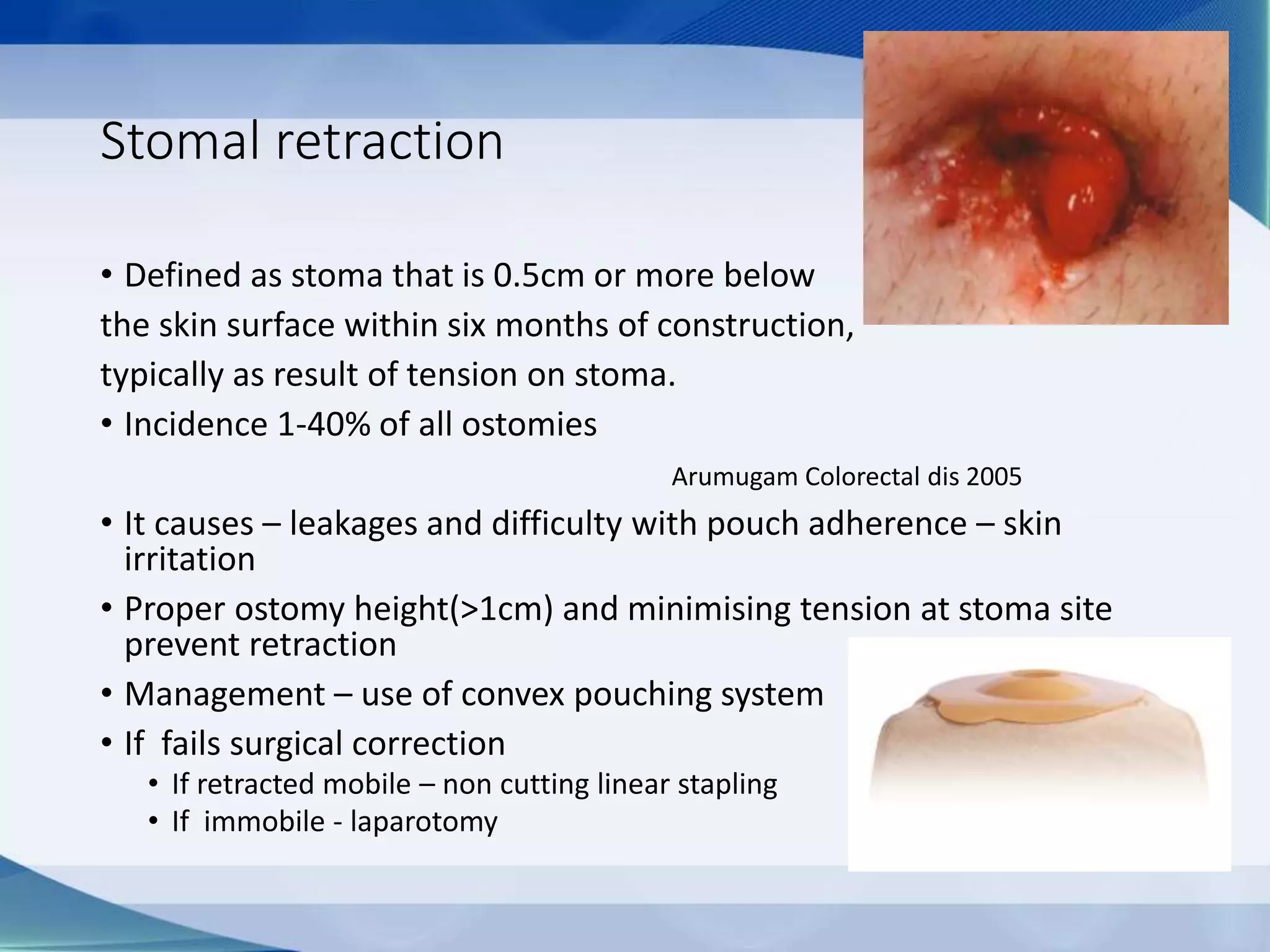 Stoma Management Ppt