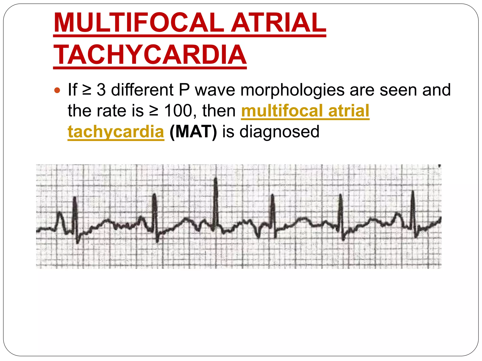 P wave (ECG) - Dr. Akif Baig | PPTX