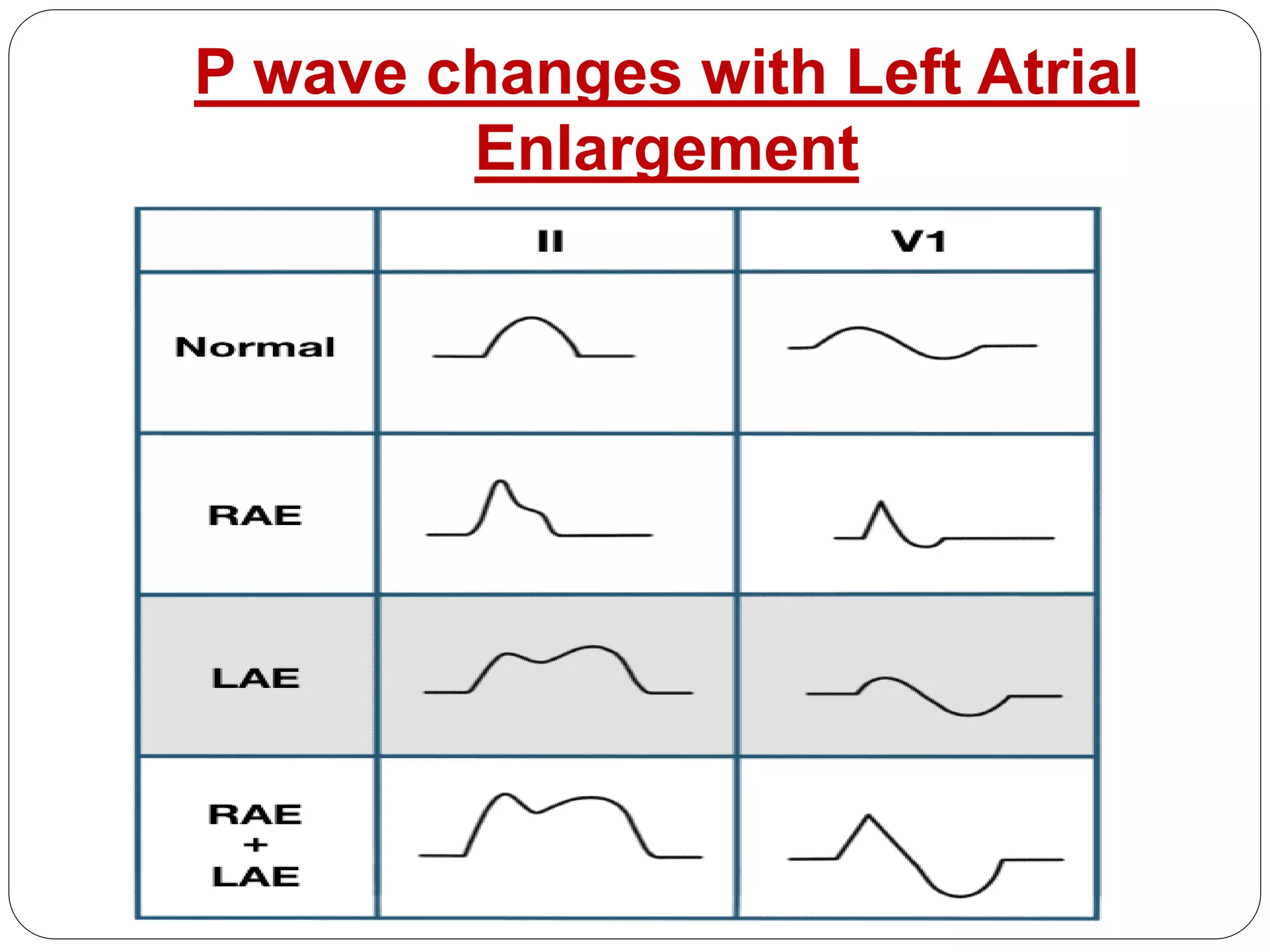 P wave (ECG) - Dr. Akif Baig | PPTX