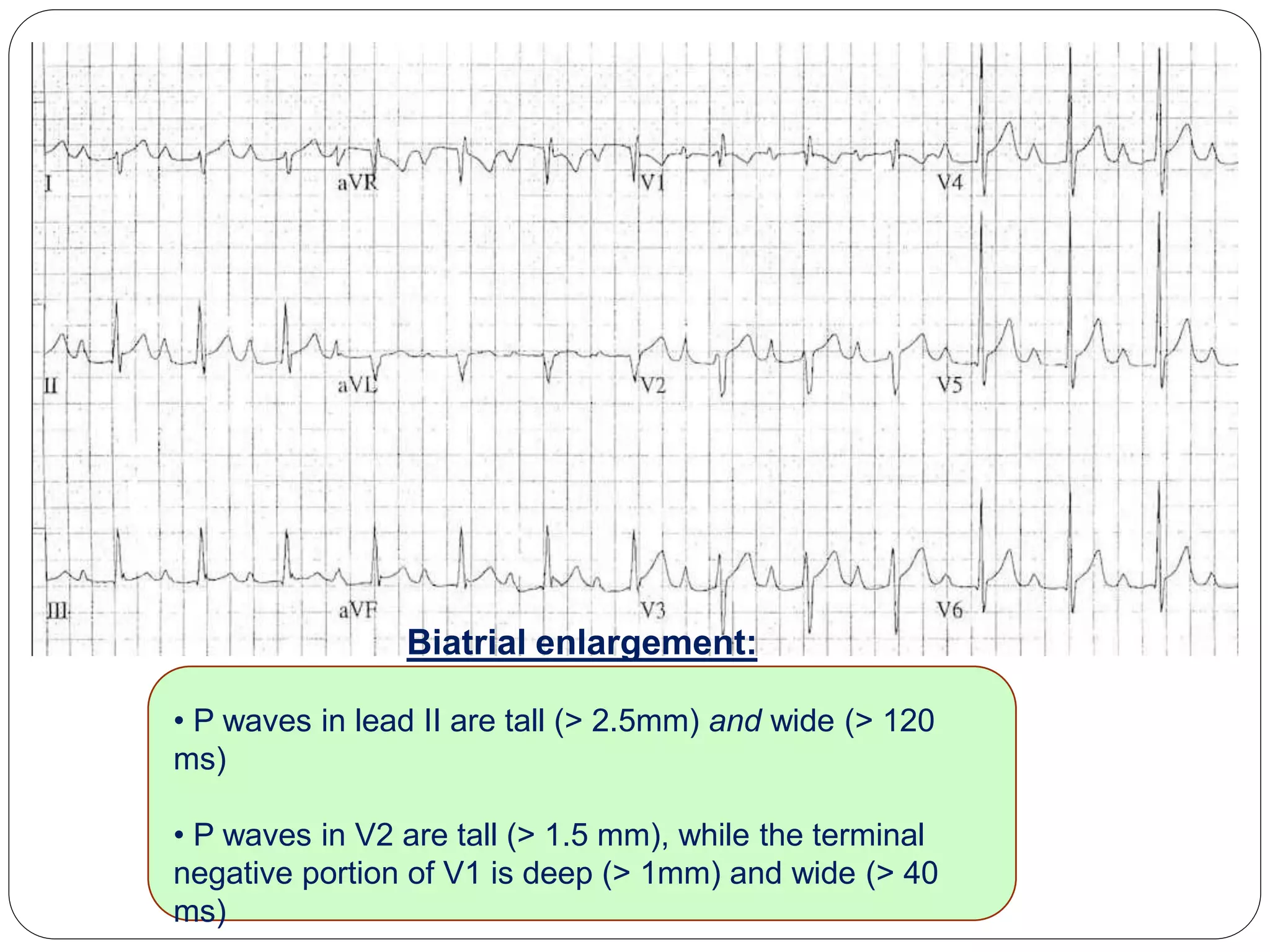 P wave (ECG) - Dr. Akif Baig | PPTX