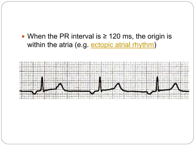 P wave (ECG) - Dr. Akif Baig | PPTX
