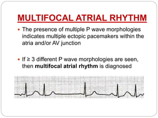 P wave (ECG) - Dr. Akif Baig | PPTX