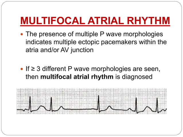 P wave (ECG) - Dr. Akif Baig | PPTX