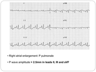 P wave (ECG) - Dr. Akif Baig | PPTX