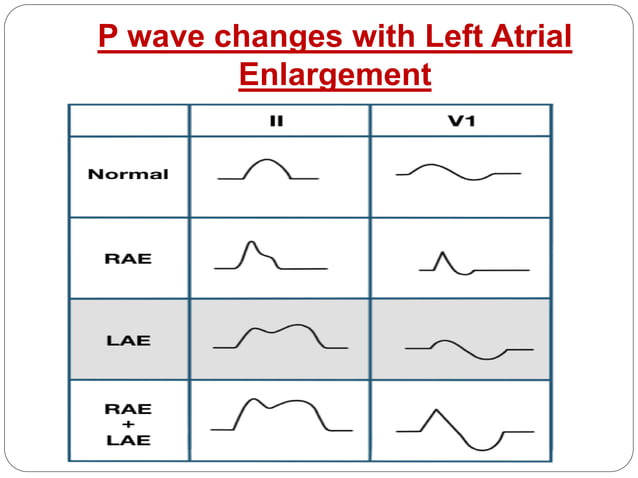P wave (ECG) - Dr. Akif Baig | PPTX
