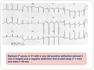 P wave (ECG) - Dr. Akif Baig | PPTX