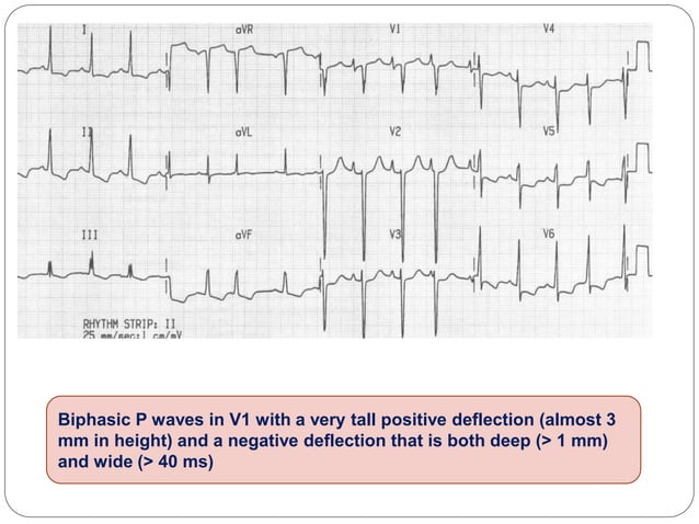P wave (ECG) - Dr. Akif Baig | PPTX