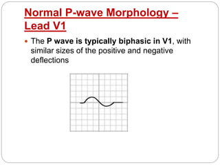 P wave (ECG) - Dr. Akif Baig | PPTX