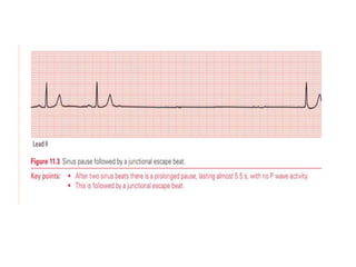 P WAVE IN ECG,ABNORMALITIES OF P WAVE IN ECG | PPTX