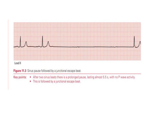 P WAVE IN ECG,ABNORMALITIES OF P WAVE IN ECG | PPTX | Heart and Cardiovascular Diseases ...