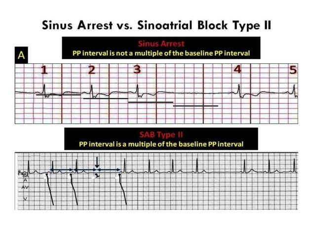 P WAVE IN ECG,ABNORMALITIES OF P WAVE IN ECG | PPTX | Heart and Cardiovascular Diseases ...