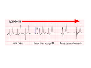 P WAVE IN ECG,ABNORMALITIES OF P WAVE IN ECG | PPTX