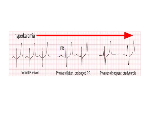 P WAVE IN ECG,ABNORMALITIES OF P WAVE IN ECG | PPTX | Heart and Cardiovascular Diseases ...