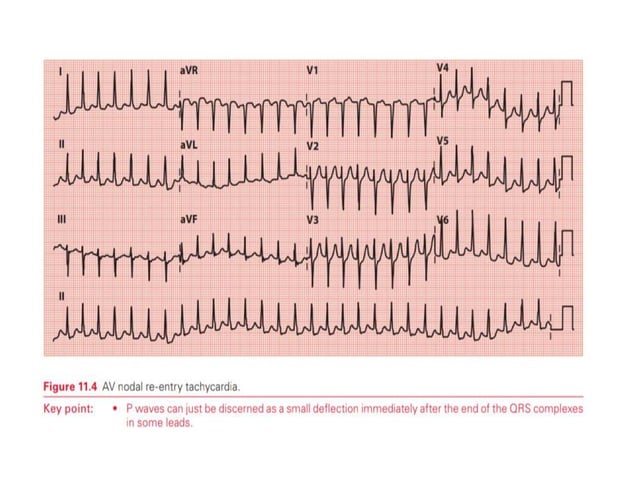 P WAVE IN ECG,ABNORMALITIES OF P WAVE IN ECG | PPTX | Heart and Cardiovascular Diseases ...