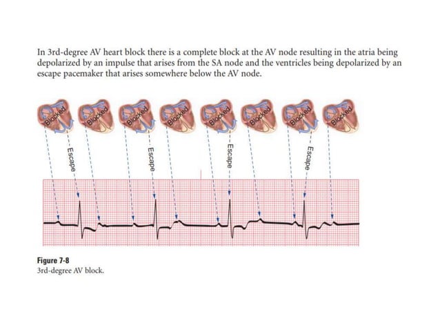 P WAVE IN ECG,ABNORMALITIES OF P WAVE IN ECG | PPTX | Heart and Cardiovascular Diseases ...