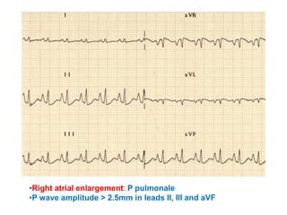 P WAVE IN ECG,ABNORMALITIES OF P WAVE IN ECG | PPTX
