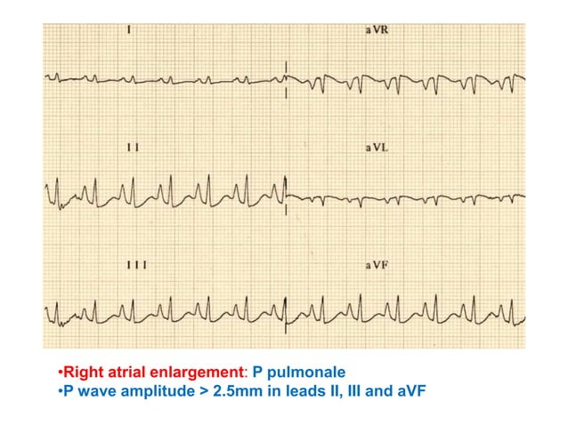 P WAVE IN ECG,ABNORMALITIES OF P WAVE IN ECG | PPTX | Heart and Cardiovascular Diseases ...