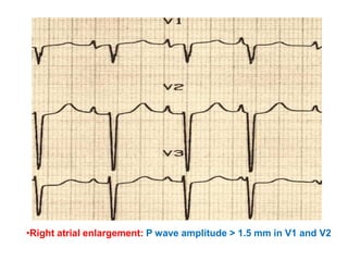 P WAVE IN ECG,ABNORMALITIES OF P WAVE IN ECG | PPTX