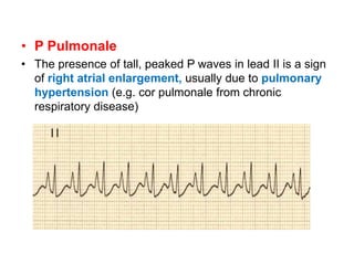 P WAVE IN ECG,ABNORMALITIES OF P WAVE IN ECG | PPTX