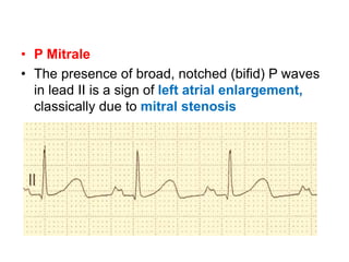 P WAVE IN ECG,ABNORMALITIES OF P WAVE IN ECG | PPTX